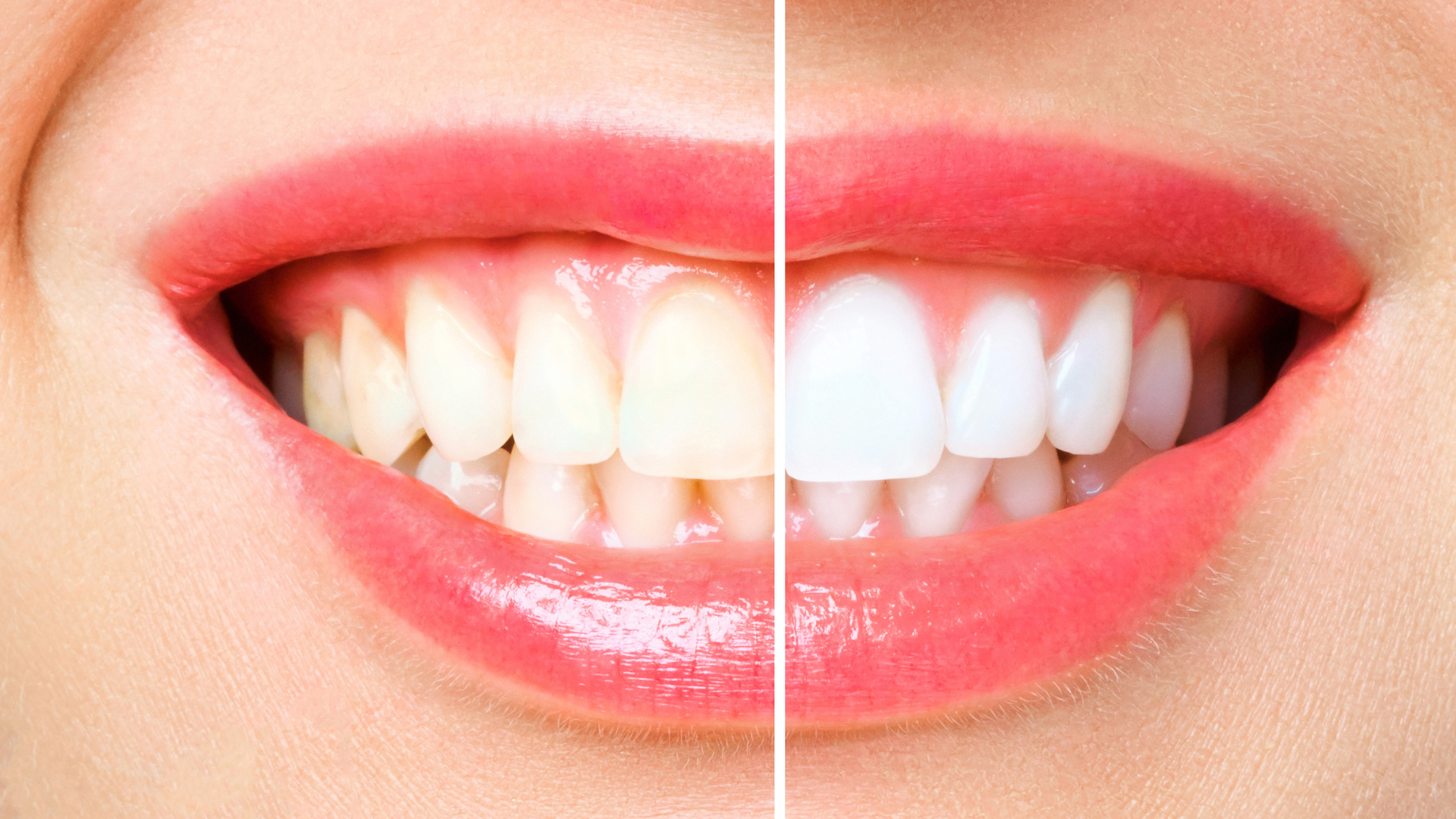 Unlock the Secret to Pearly Whites—Without Harsh Chemicals ...